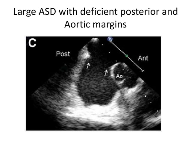 ECHO ASSESSMENT OF ASD FOR DEVICE CLOSURE | PPTX | 3-D Graphics ...