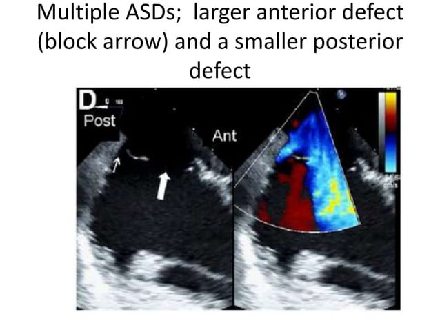 ECHO ASSESSMENT OF ASD FOR DEVICE CLOSURE | PPTX | 3-D Graphics ...