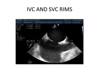 ECHO ASSESSMENT OF ASD FOR DEVICE CLOSURE | PPTX