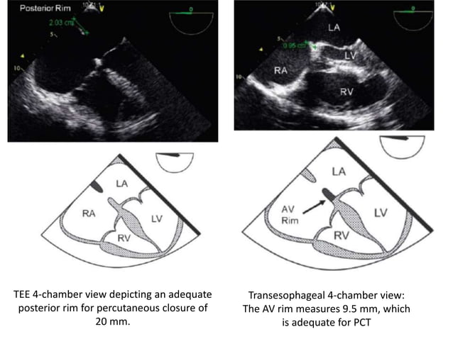 ECHO ASSESSMENT OF ASD FOR DEVICE CLOSURE | PPTX | 3-D Graphics ...