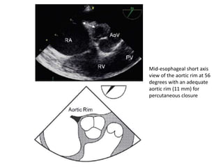 ECHO ASSESSMENT OF ASD FOR DEVICE CLOSURE | PPTX