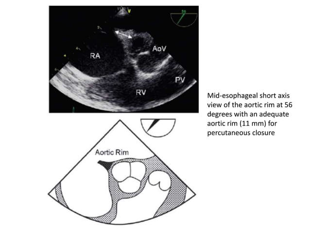 ECHO ASSESSMENT OF ASD FOR DEVICE CLOSURE | PPTX | 3-D Graphics ...