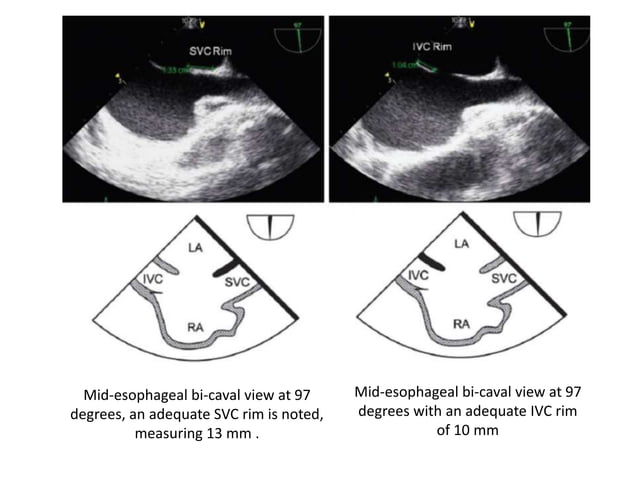 ECHO ASSESSMENT OF ASD FOR DEVICE CLOSURE | PPTX | 3-D Graphics ...