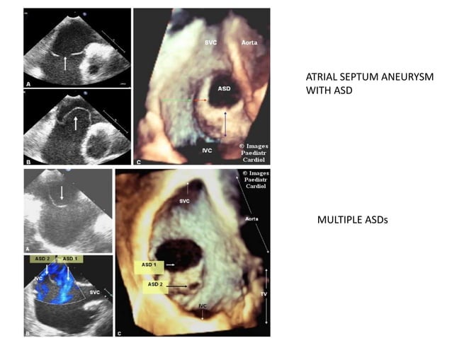 ECHO ASSESSMENT OF ASD FOR DEVICE CLOSURE | PPTX | 3-D Graphics ...