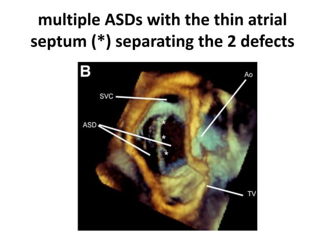ECHO ASSESSMENT OF ASD FOR DEVICE CLOSURE | PPTX | 3-D Graphics ...