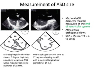 ECHO ASSESSMENT OF ASD FOR DEVICE CLOSURE | PPTX