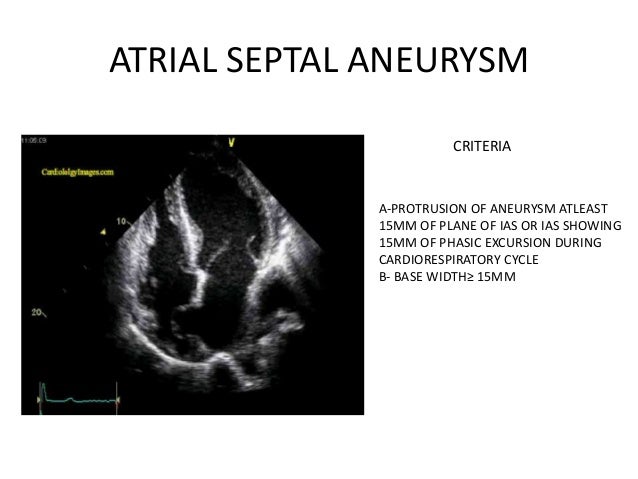 ECHO ASSESSMENT OF ASD FOR DEVICE CLOSURE
