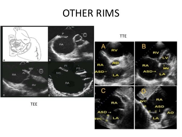 ECHO ASSESSMENT OF ASD FOR DEVICE CLOSURE