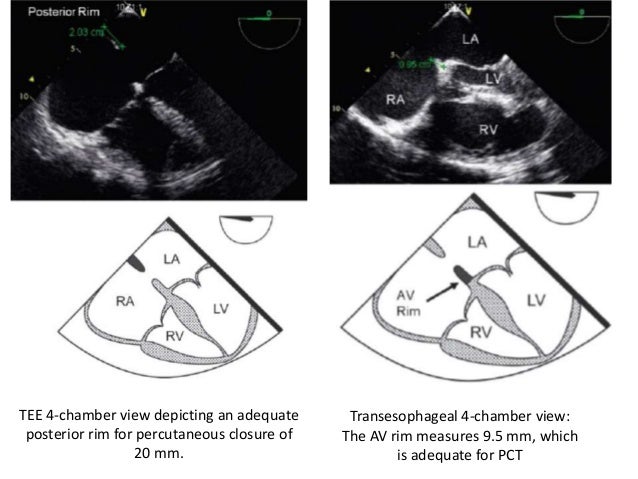 ECHO ASSESSMENT OF ASD FOR DEVICE CLOSURE