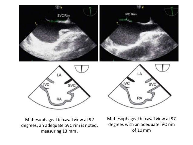 ECHO ASSESSMENT OF ASD FOR DEVICE CLOSURE