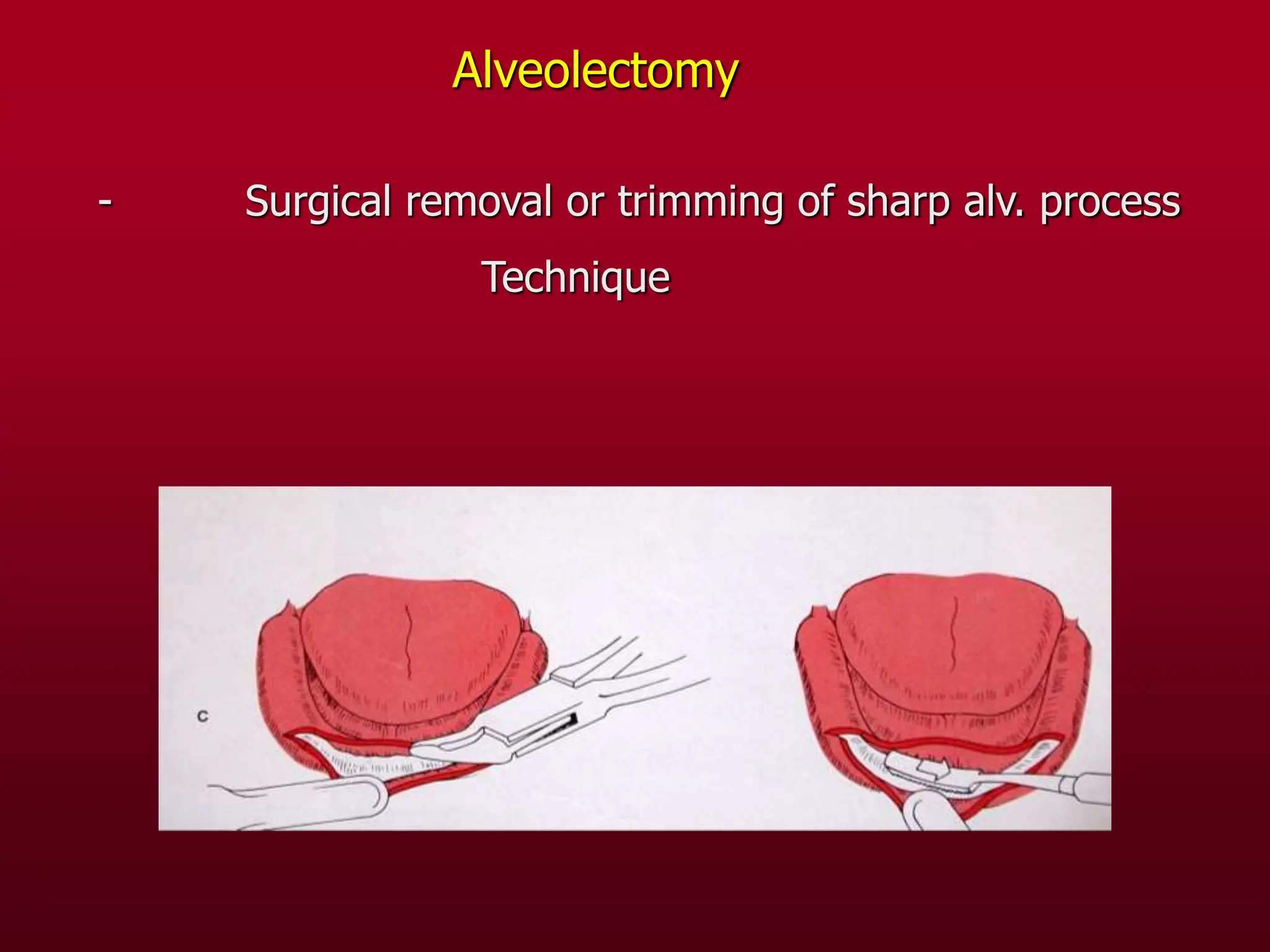 preprosthetic surgery hard and soft tissue.ppt