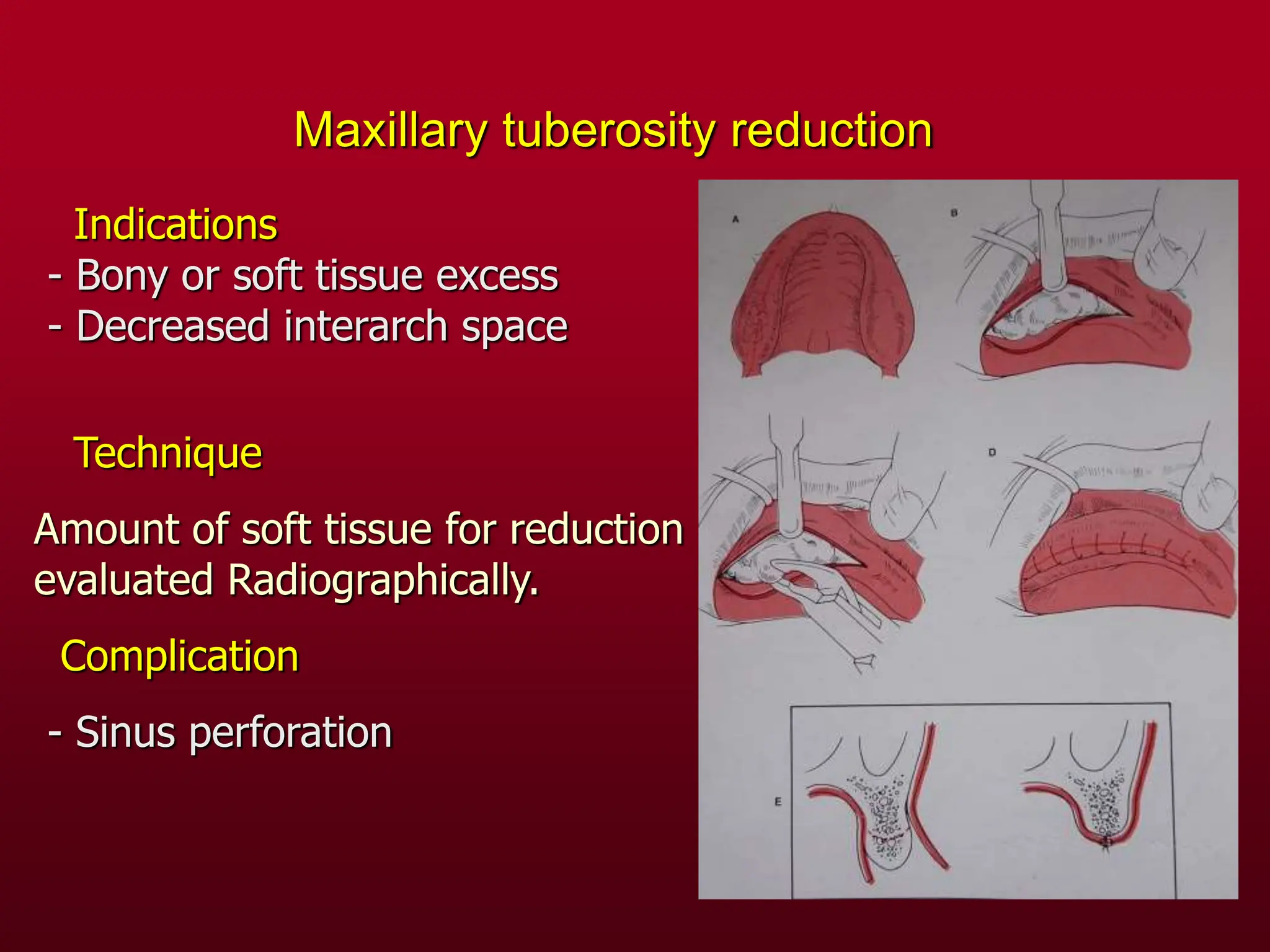 preprosthetic surgery hard and soft tissue.ppt