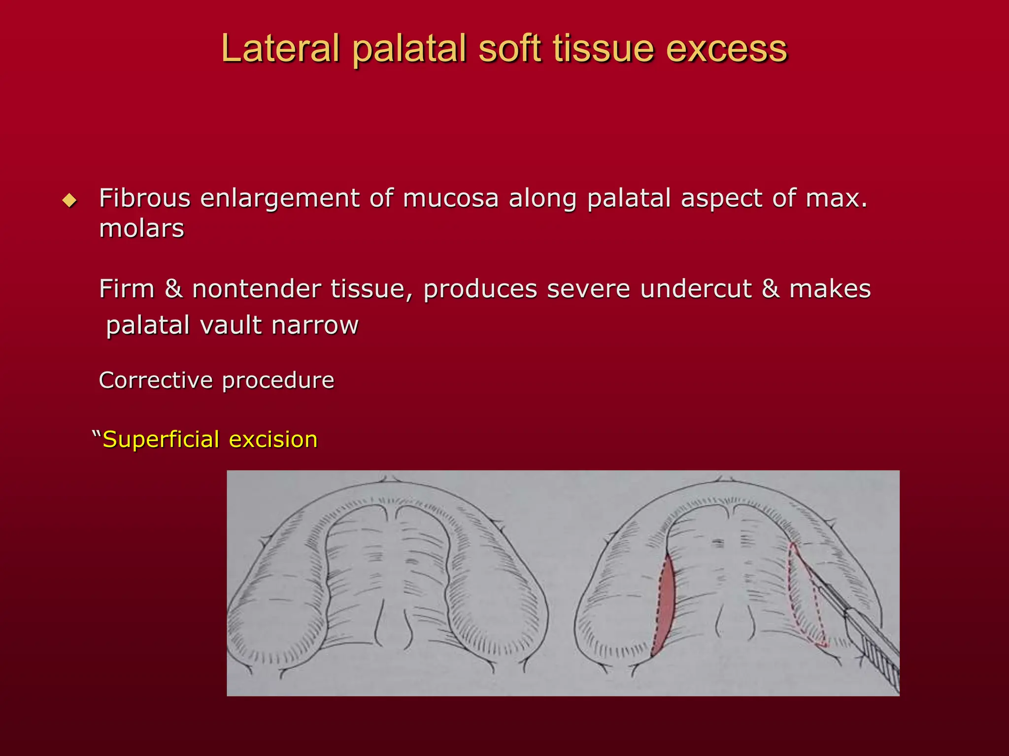 preprosthetic surgery hard and soft tissue.ppt