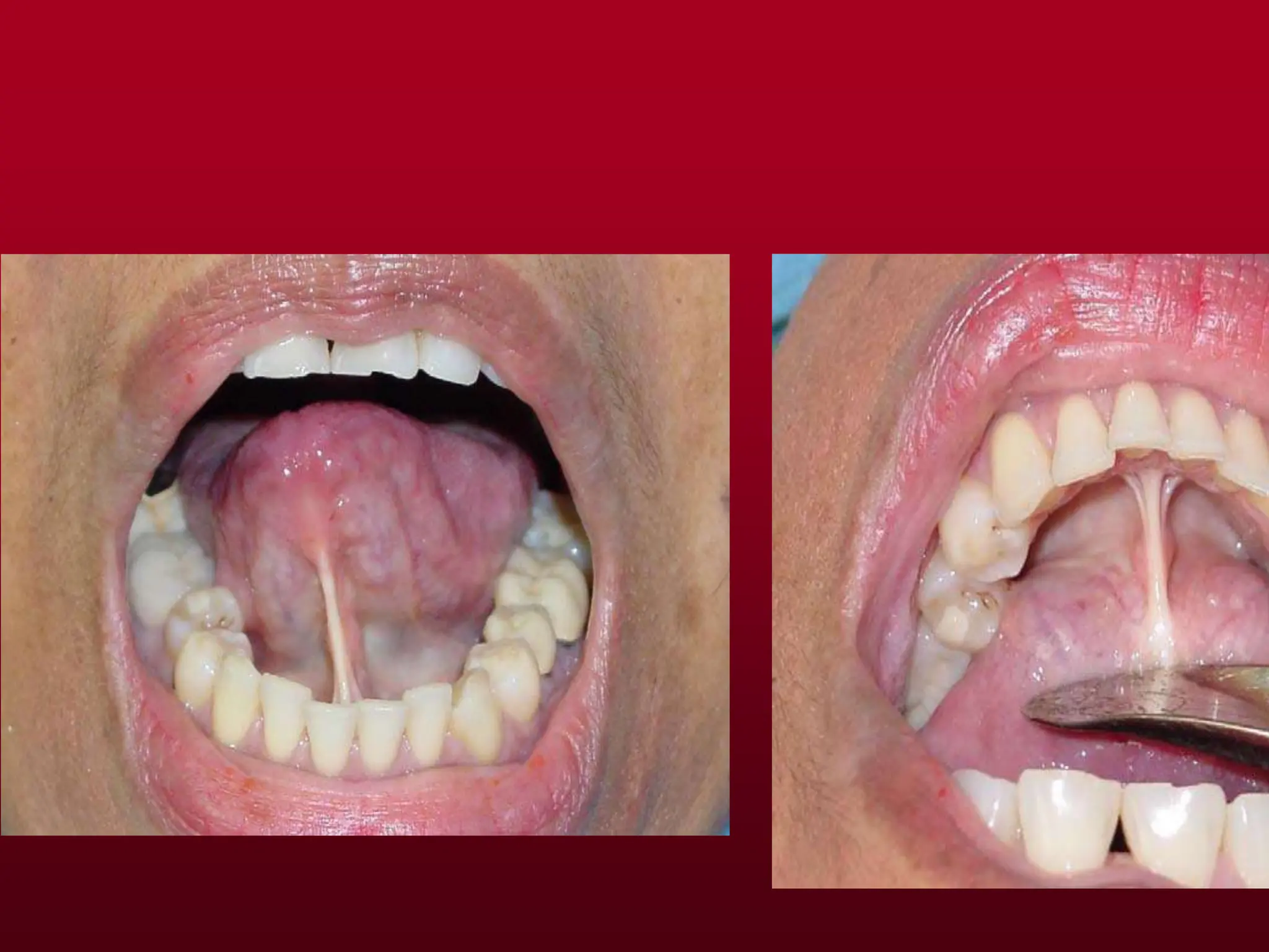 preprosthetic surgery hard and soft tissue.ppt