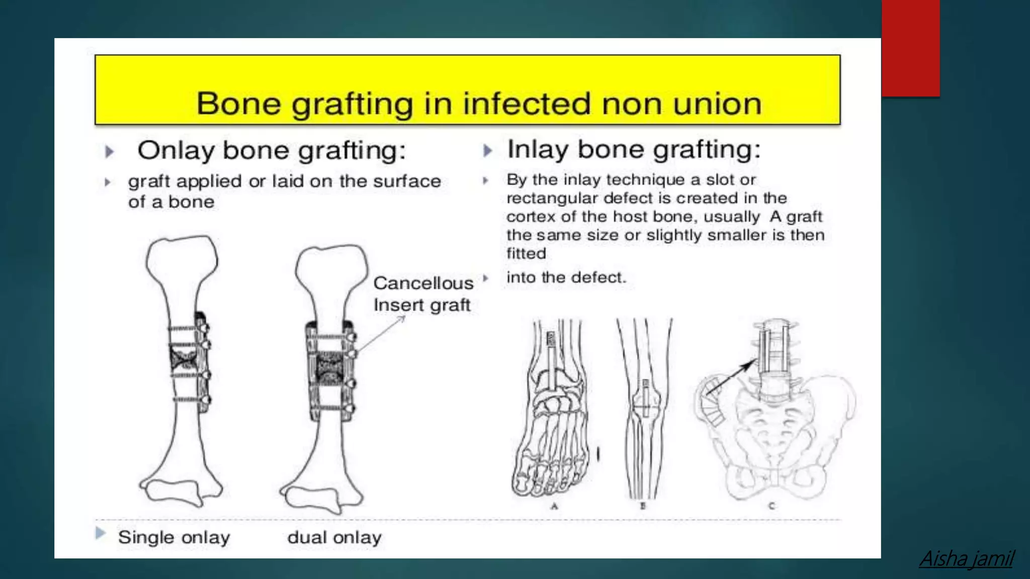 Indications and pre-prosthetic procedures For making prosthesis - DR ...