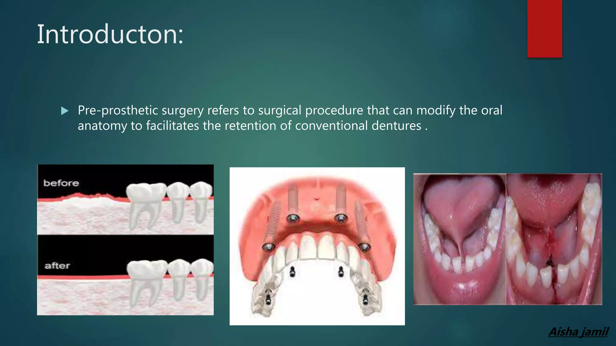 Indications and pre-prosthetic procedures For making prosthesis - DR ...