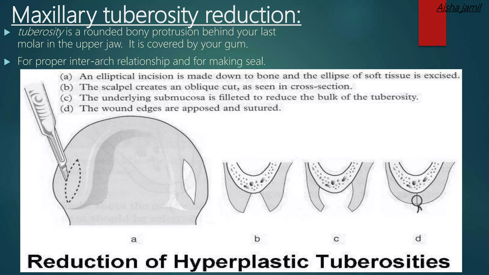 Indications and pre-prosthetic procedures For making prosthesis - DR ...