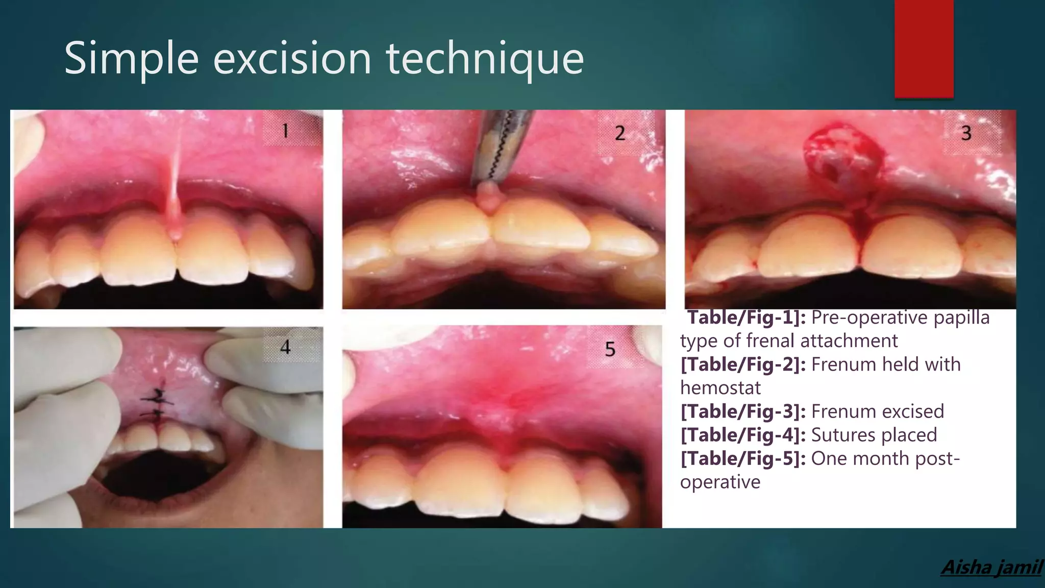Indications and pre-prosthetic procedures For making prosthesis - DR ...