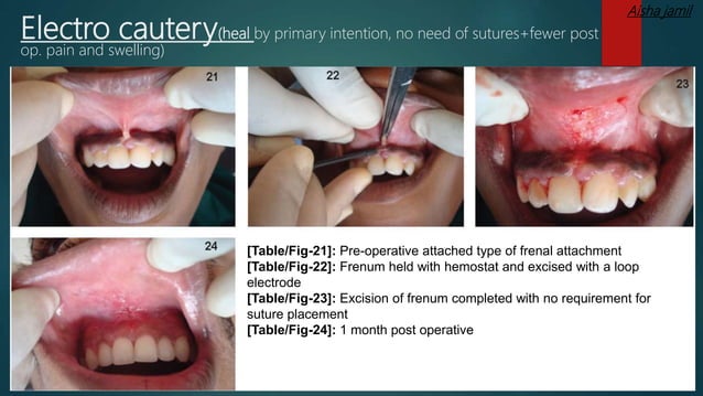 Indications and pre-prosthetic procedures For making prosthesis - DR ...