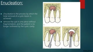 Indications and pre-prosthetic procedures For making prosthesis - DR ...