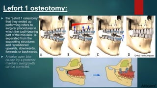 Indications and pre-prosthetic procedures For making prosthesis - DR ...