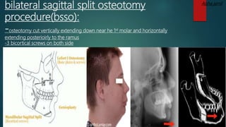Indications and pre-prosthetic procedures For making prosthesis - DR ...
