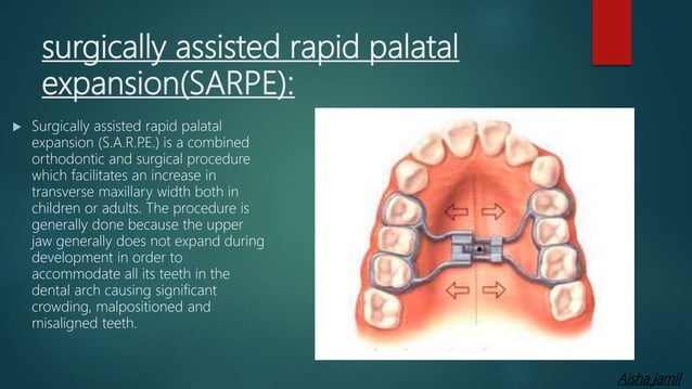 Indications and pre-prosthetic procedures For making prosthesis - DR ...