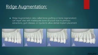 Indications and pre-prosthetic procedures For making prosthesis - DR ...