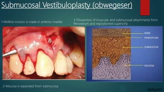 Indications and pre-prosthetic procedures For making prosthesis - DR ...