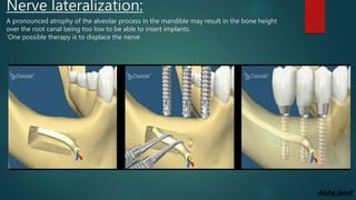 Indications and pre-prosthetic procedures For making prosthesis - DR ...