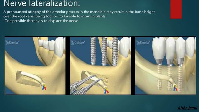 Indications and pre-prosthetic procedures For making prosthesis - DR ...
