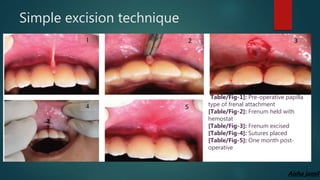 Indications and pre-prosthetic procedures For making prosthesis - DR ...