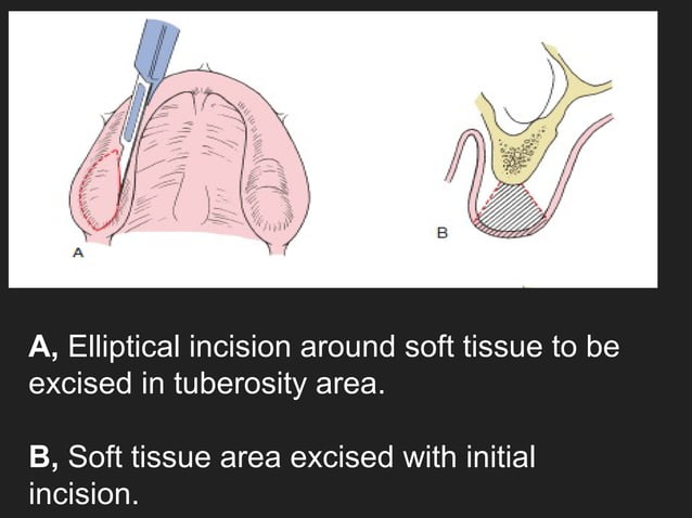 Pre prosthetic surgeries | PPT