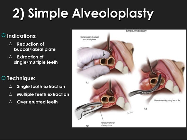 Pre prosthetic surgeries