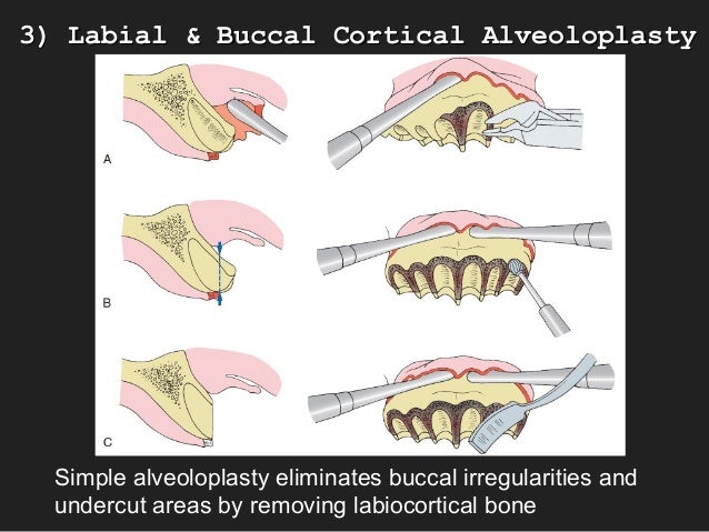 Pre prosthetic surgeries
