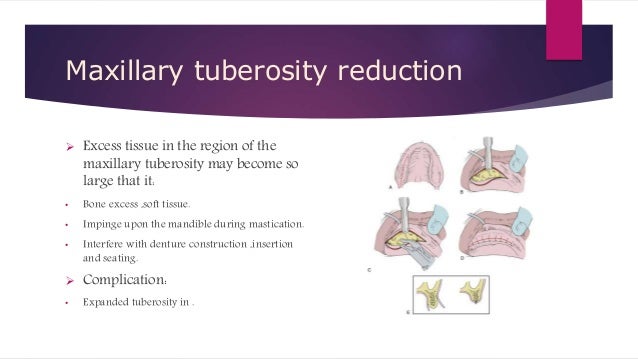 Pre prosthetic surgery