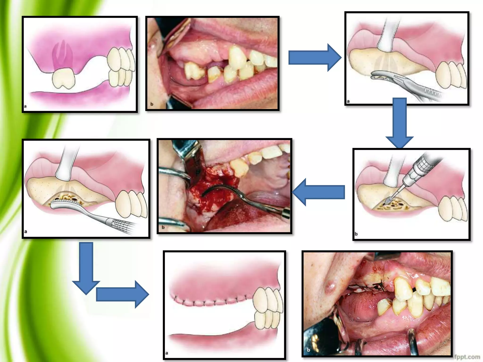 Pre prosthetic surgery | PPTX