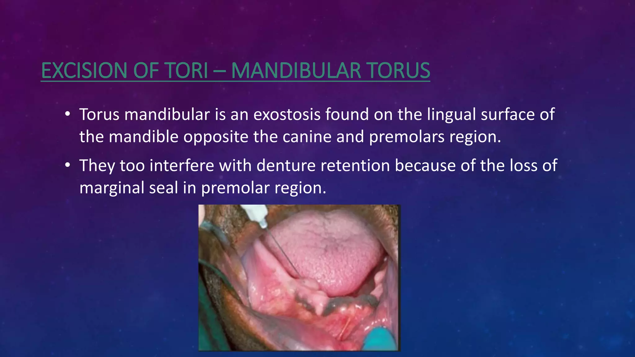 Preprosthetic surgery; Prosthodontic consideraration | PPTX