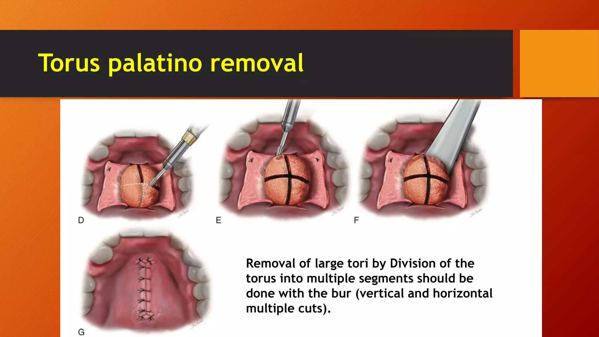 Pre prosthetic surgery | PPTX