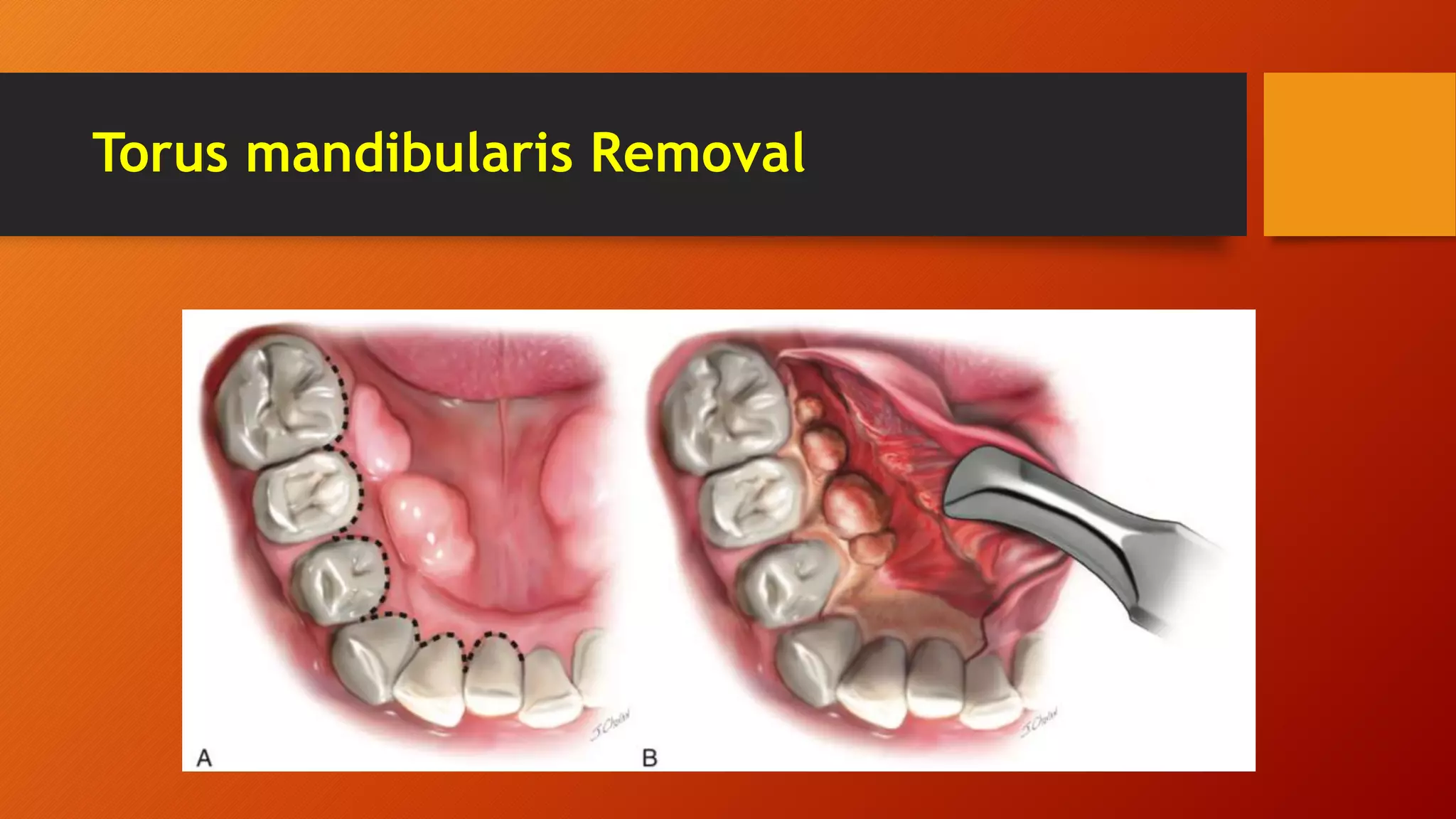 Pre prosthetic surgery | PPTX