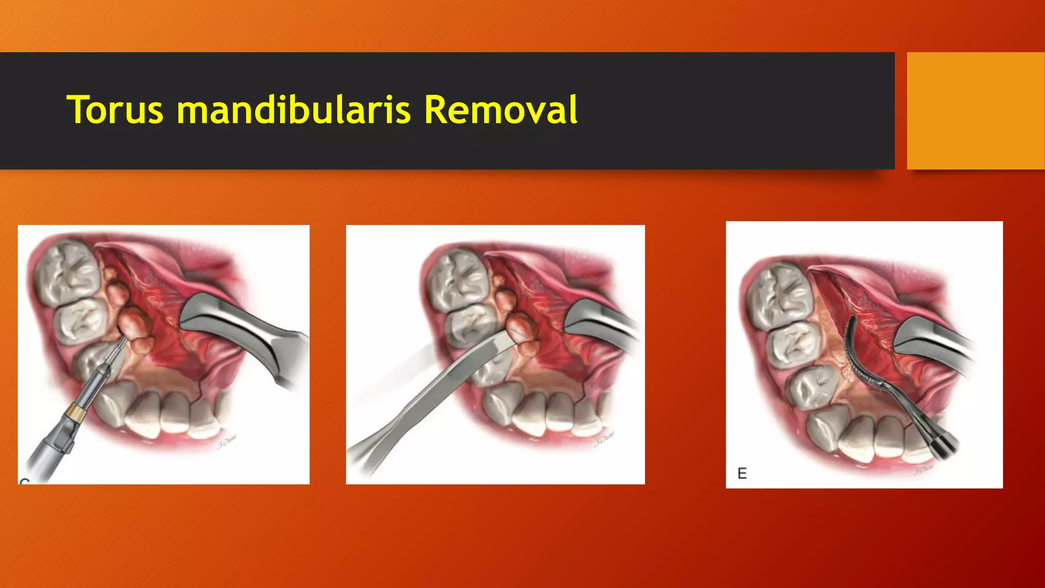 Pre prosthetic surgery | PPTX