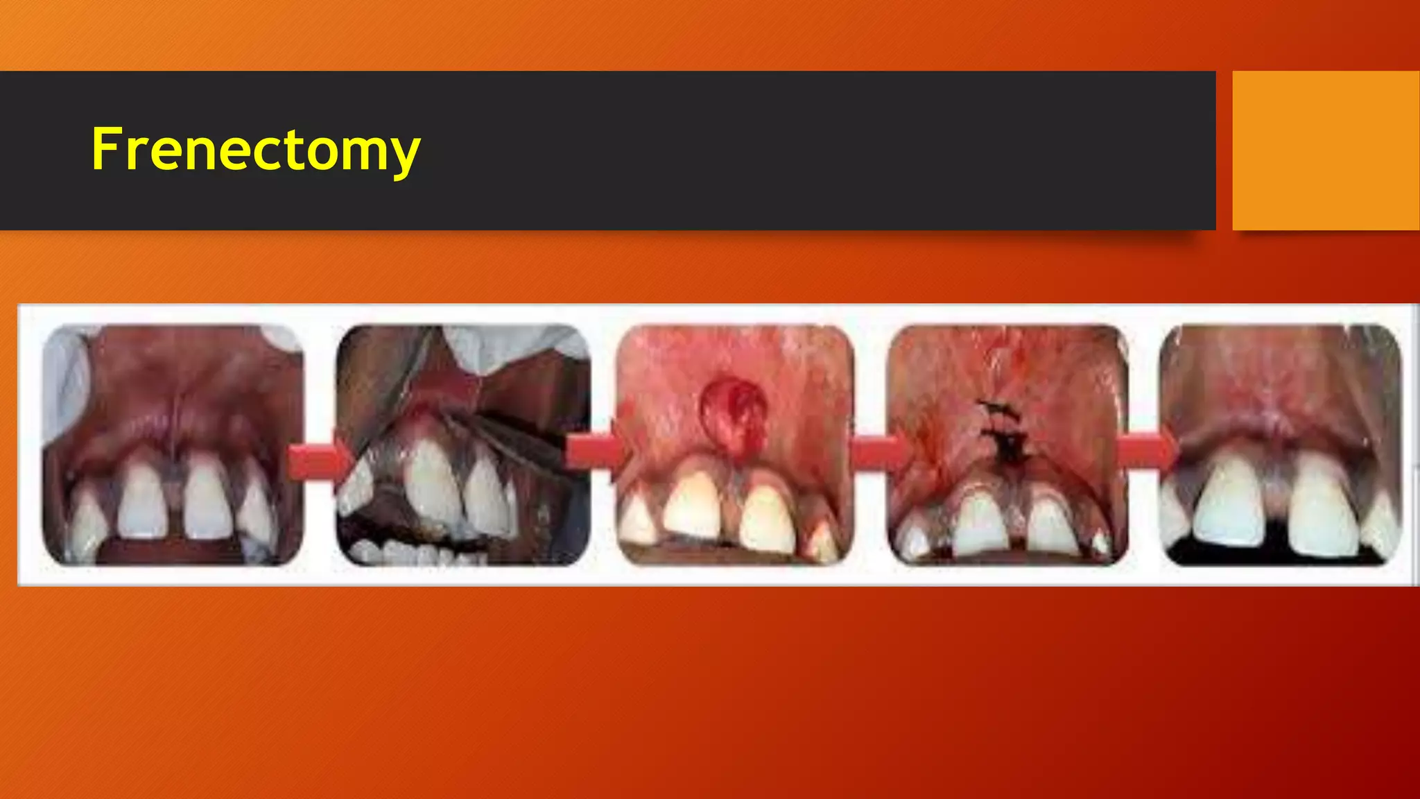 Pre prosthetic surgery | PPTX