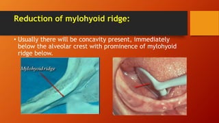 Mylohyoid Ridge Reduction