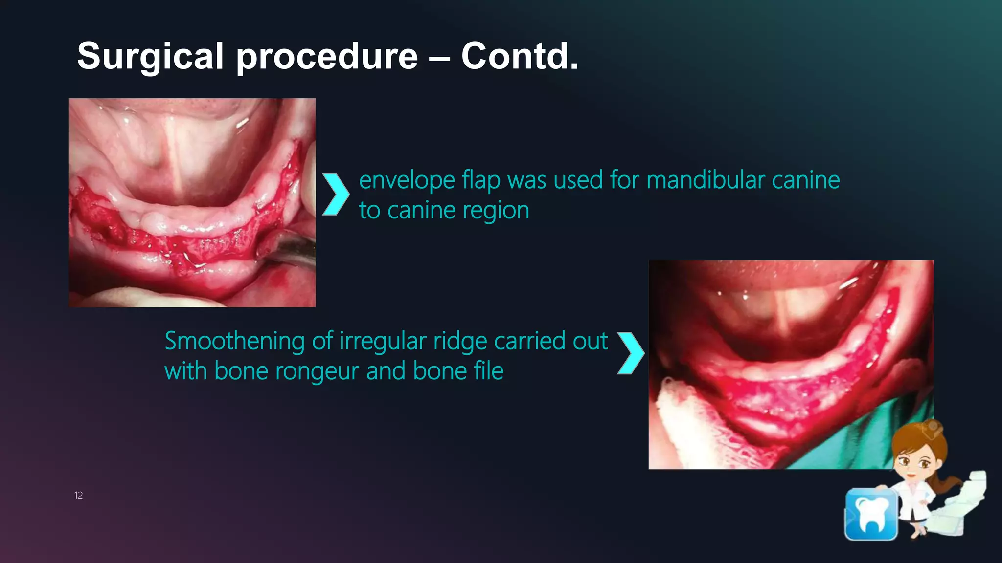 Preprosthetic Surgery | PPTX