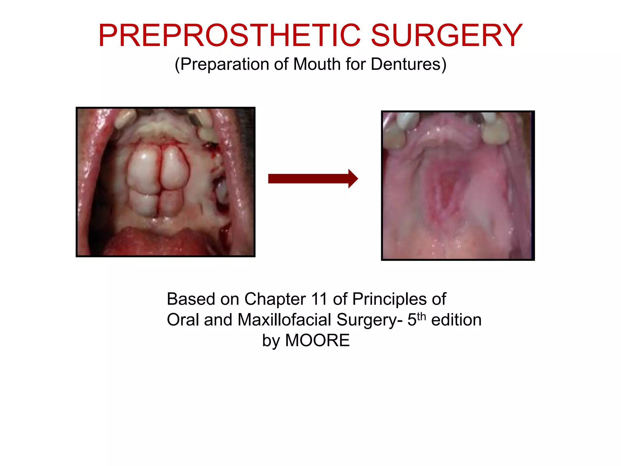 Preprosthetic surgery.pdf
