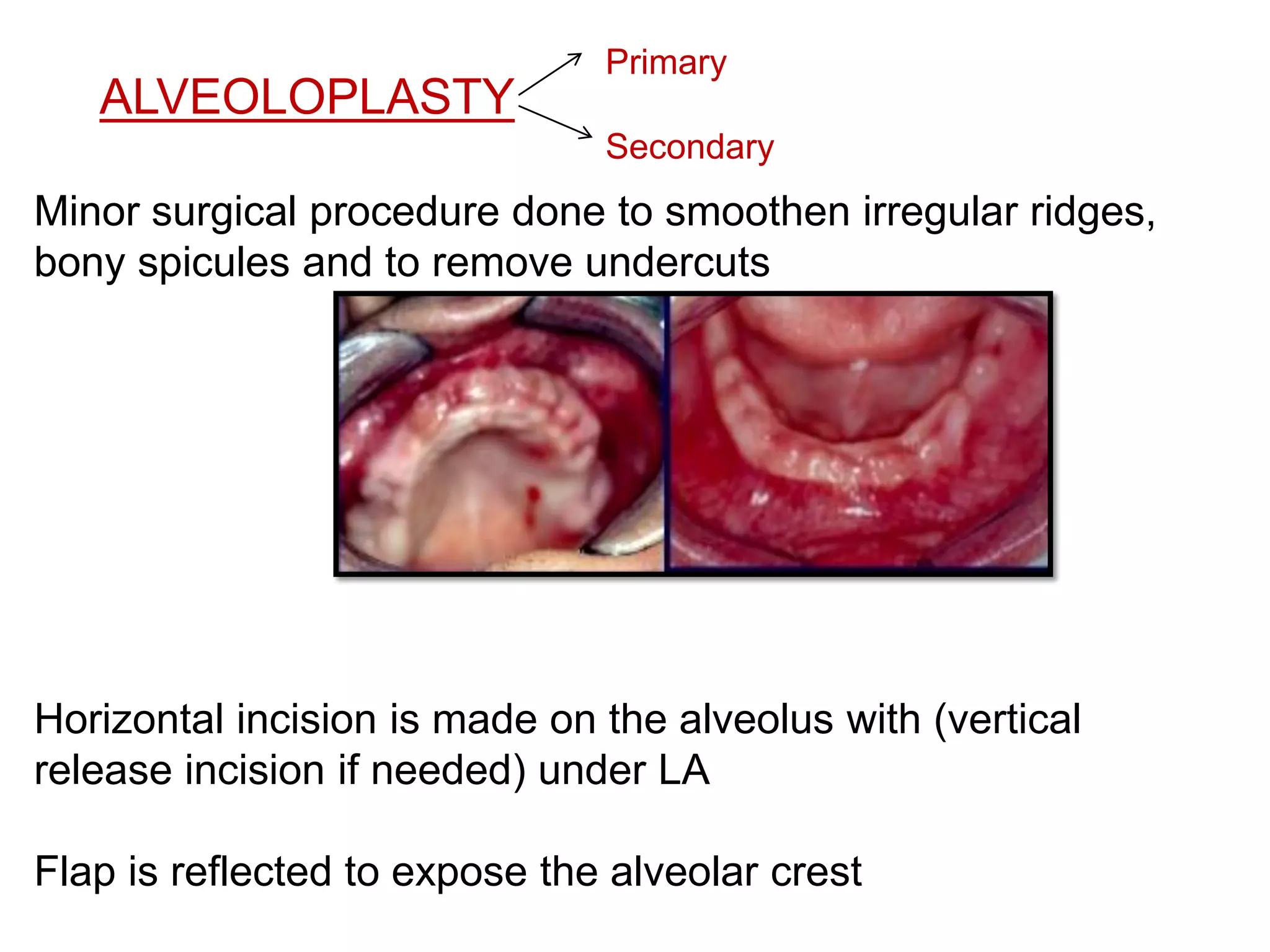 Preprosthetic surgery.pdf