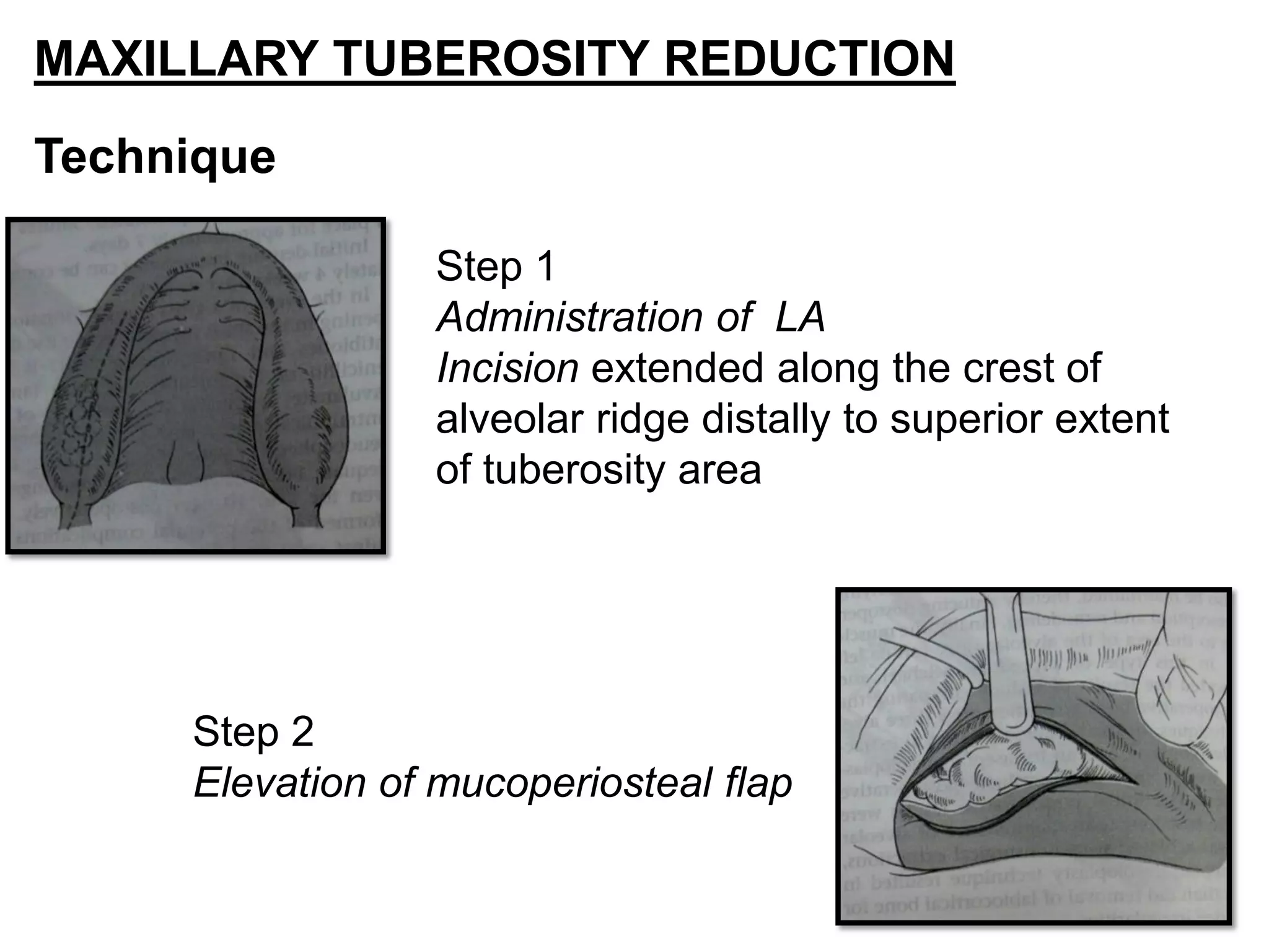 Preprosthetic surgery.pdf