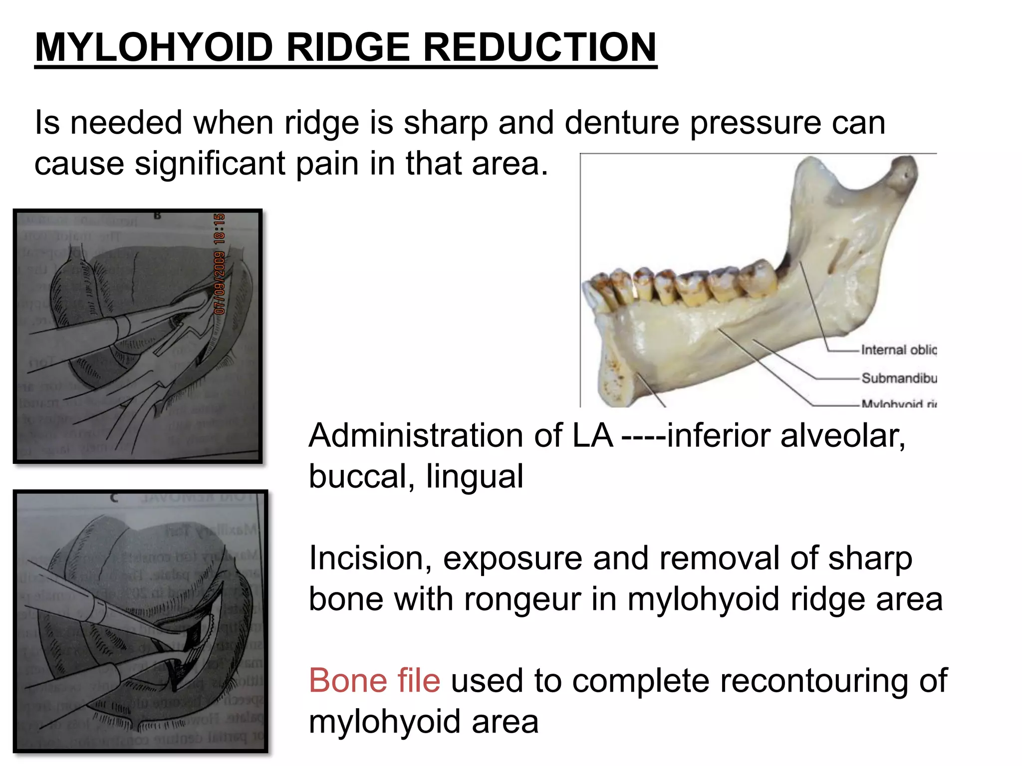 Preprosthetic surgery.pdf