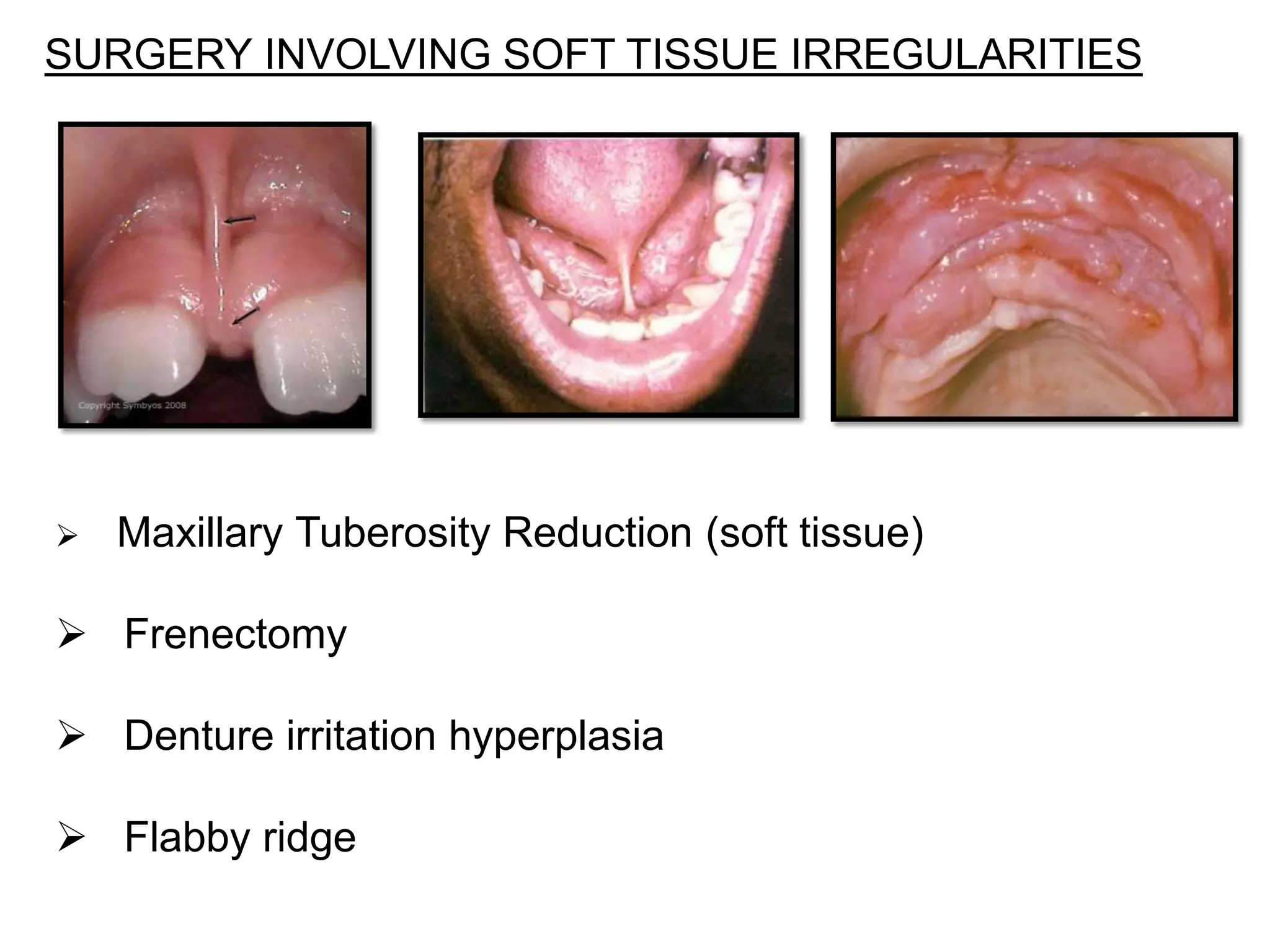 Preprosthetic surgery.pdf