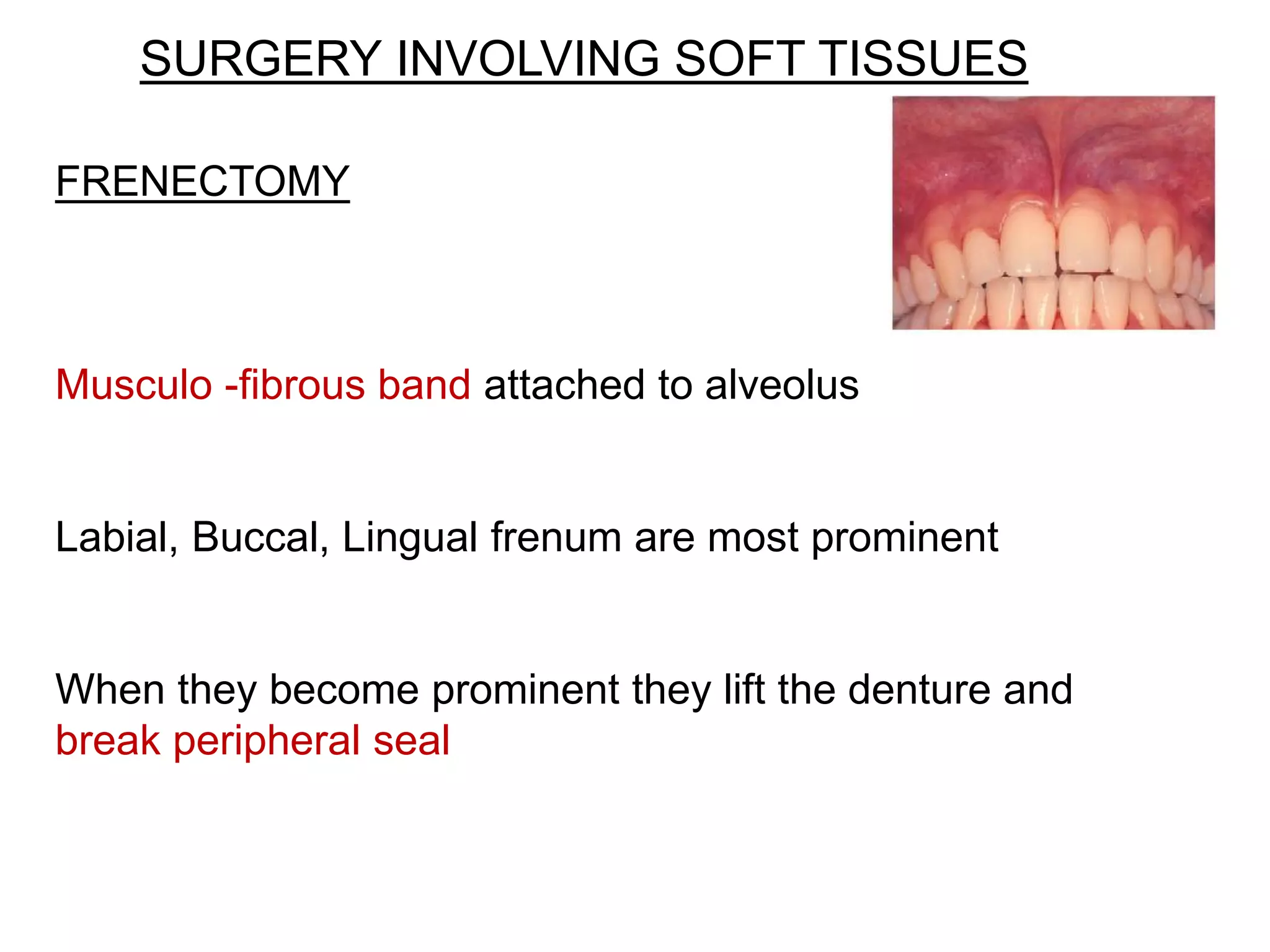 Preprosthetic surgery.pdf